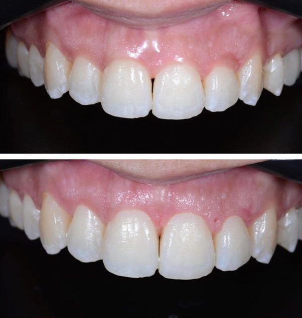 Periodontia, o que é? - Entenda Tudo Sobre Periodontia - Itaim Bibi SP